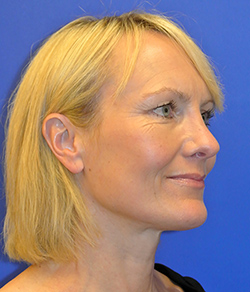 Nose Dr Philbin 1 | Edina Plastic Surgery