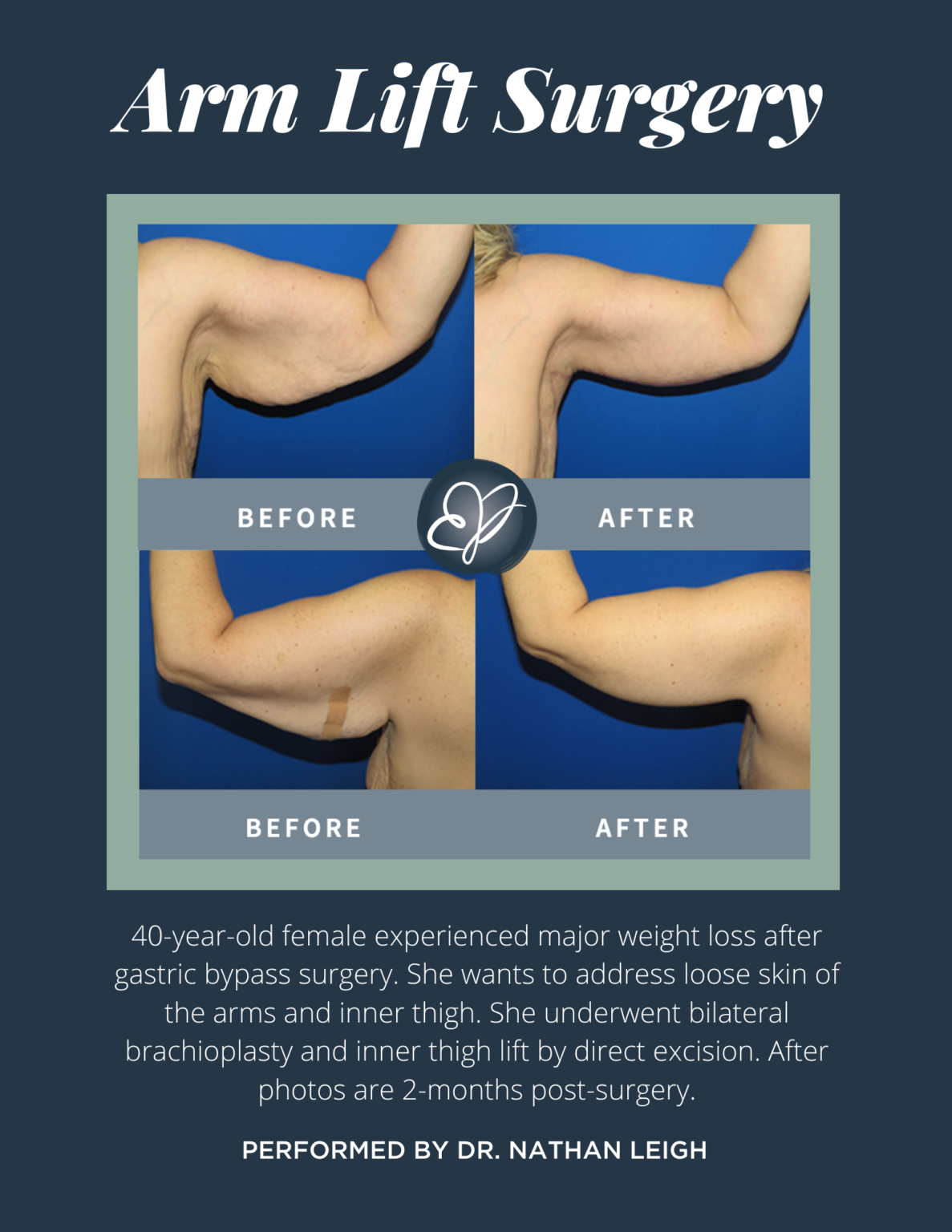 Arm Lift Surgery – Your Timeline to Recovery & Top Tips for Healing ...