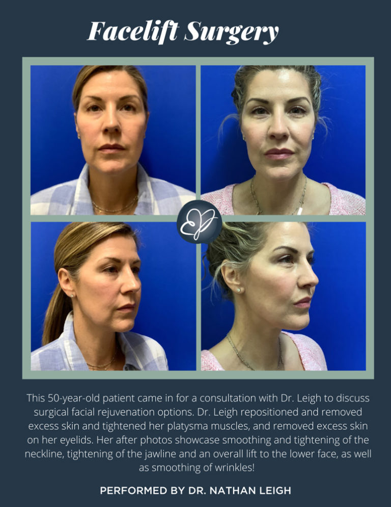 The Ponytail Facelift – Trend VS Truth | Edina Plastic Surgery