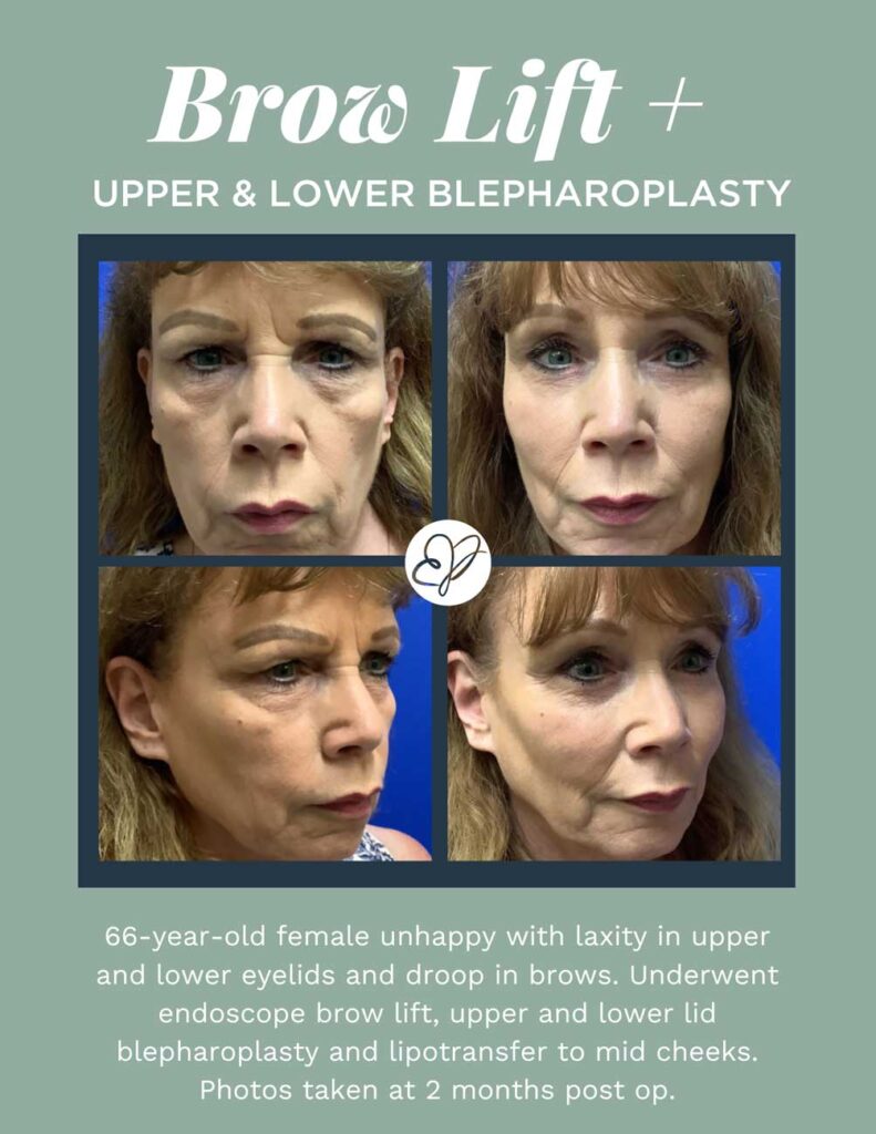3 Ways Brow Lift Surgery Can Make You Look Younger | Edina Plastic Surgery