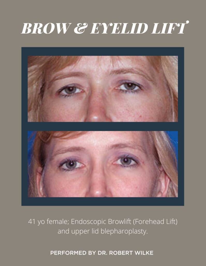 Brow Lift VS Eyelid Lift – Which One is Right for Me? | Edina Plastic ...