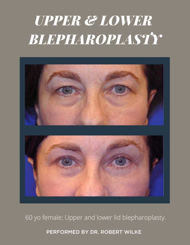 Brow Lift VS Eyelid Lift – Which One is Right for Me? | Edina Plastic ...