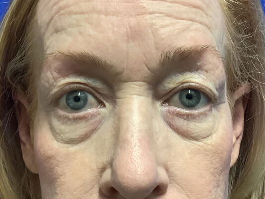 Eyelid Dr. Philbin 3 | Edina Plastic Surgery