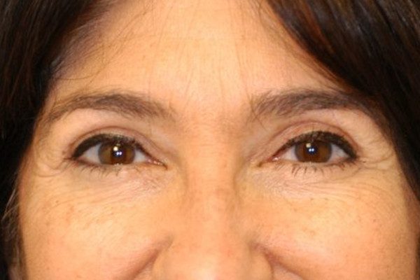 blepharo-6-after-front-kobienia | Edina Plastic Surgery